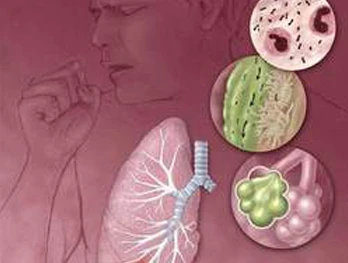 Phê chuẩn Telavancin để điều trị viêm phổi